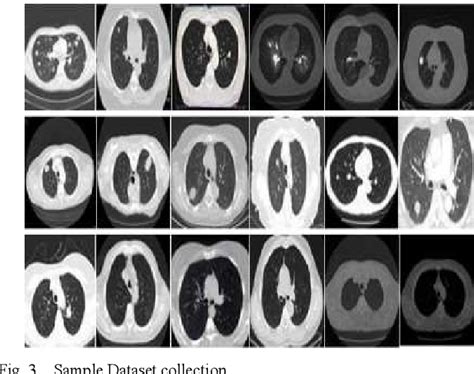 Figure 3 From Artificial Intelligence Based Lung Cancer Prediction Using Convolutional Neural