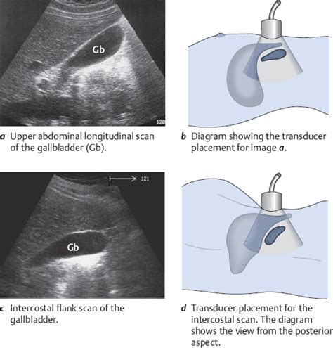 Gallbladder Ultrasound Probe Positioning Transducer 45 Off