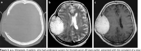 Figure 2 From Ct And Mri Findings In Calvarial Non Infectious Lesions