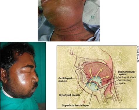 Medicodental Cpg Management Unerupted And Impacted Third Molar