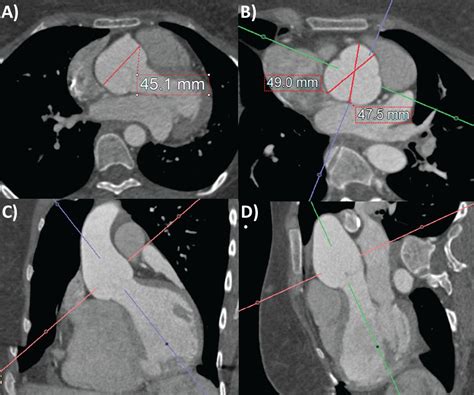 Diagnosing Ascending Aortic Aneurysms Screening Tests And Imaging Techniques The Aneurysm