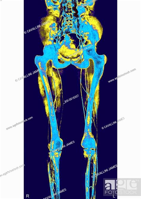 Deep Vein Thrombophlebitis Of Both Legs Phlebography Of The Lower