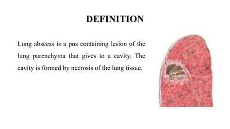 Lung Abscess102210pptx