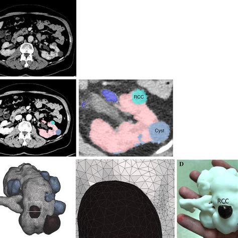 Workflow From Dicom Image To 3d Printed Model A Source Dicom Stack