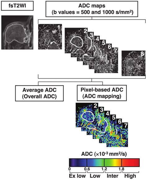 Overall ADC And ADC Mapping MR Images Are From A 77 Year Old Man With Download Scientific