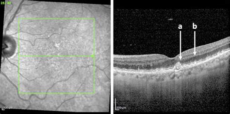 Sd Oct Image Depicting Drusen Types Above The Rpe Sdd A And Below Download Scientific