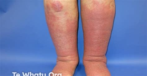 Acute Lipodermatosclerosis Image