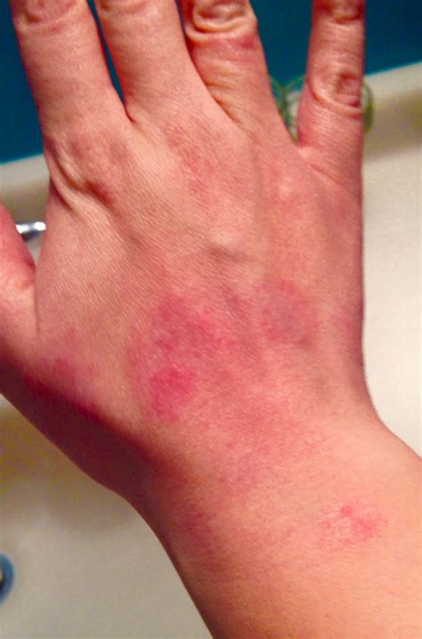 Homeopathic Medicines For Hookworm Infection Drhomeo Homeopathy