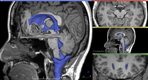 Segmentation Of A Brain Ventricular System Visualized By The Download Scientific Diagram