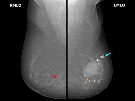 Eggshell Calcification