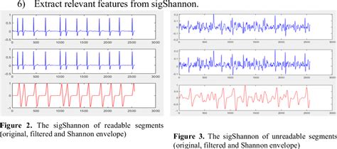 Figure 1 From Unreadable Segment Recognition Of Single Lead Ecg Signals Based On Xgboost