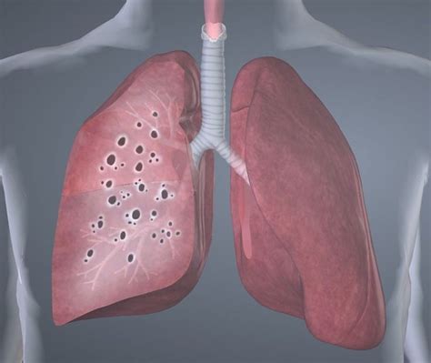 Саркоидоз легких что это такое симптомы и лечение