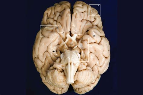 30 Facts About Sliding Uncus Syndrome