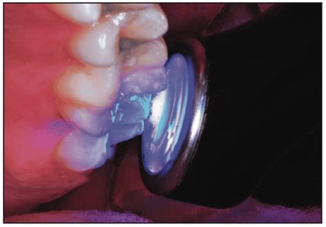 Smooth Surface Dental Caries And Decalcification Restoration And Reinforced Sealant Application