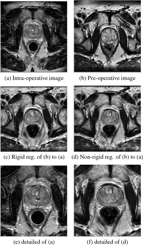 Figure 3 From Multimodal Nonrigid Registration Using A Stochastic Gradient Approximation