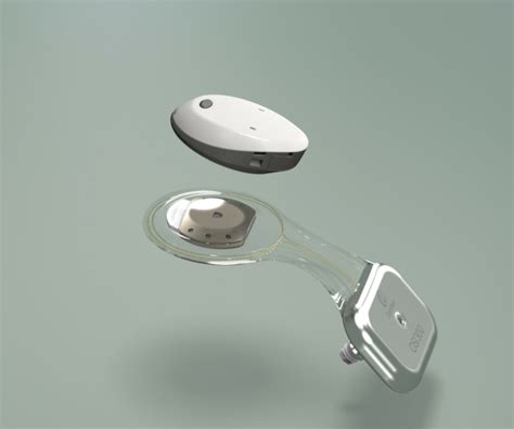 Cochlear Device Processor And Hearing Implants Blogs Cochlear Pronews