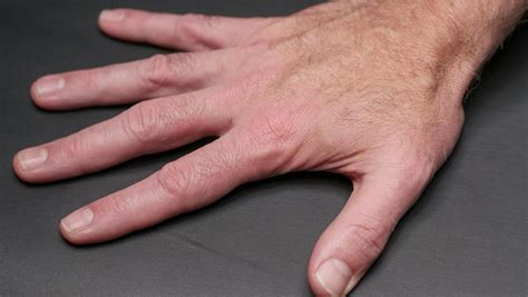 Dawsons Fingers And Multiple Sclerosis Understanding The Connection