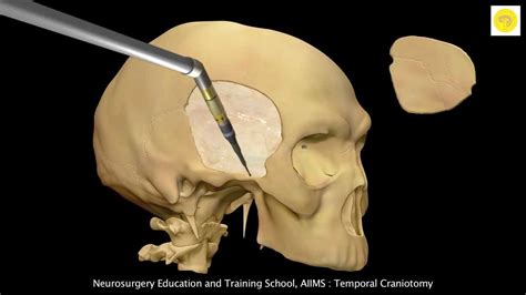 Neurosurgery 3d Animation Video Temporal Craniotomy Youtube