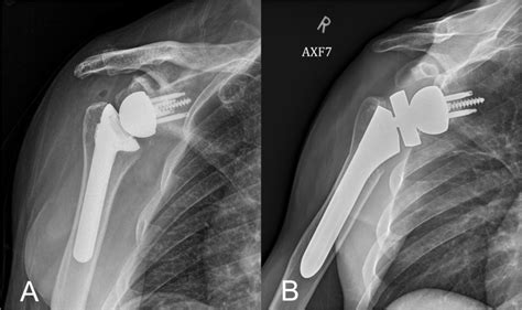 Reverse Total Shoulder Arthroplasty With Inlay Humeral Component A Download Scientific