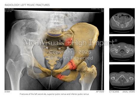 Pelvic Fracture Illustration Medivisuals High Impact
