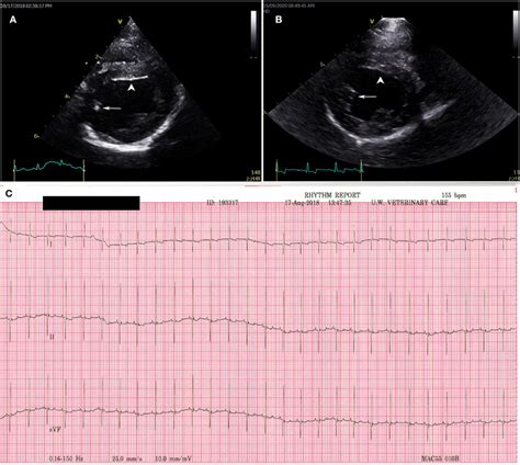 Normal Echocardiogram Results I Had Echocardiogram Please Explain