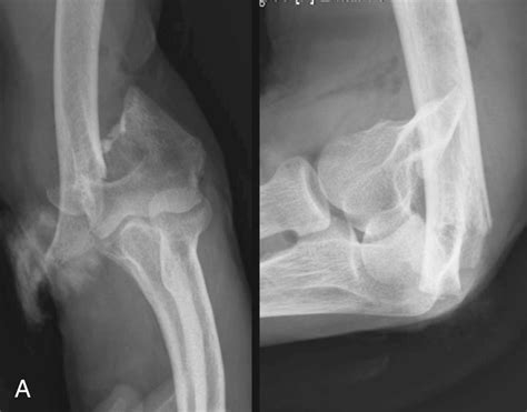 Low Transcondylar Fractures Of The Distal Humerus Clinical Tree