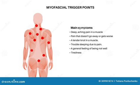 Myofascial Trigger Points Cartoon Vector 309901731