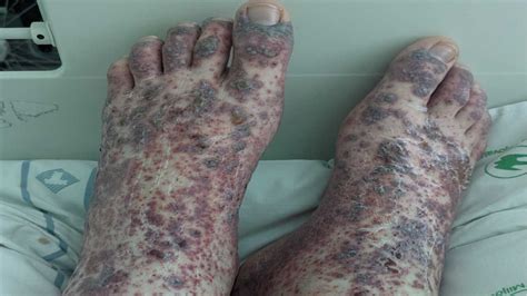 Henoch Schönlein Purpura Hsp Causes Symptoms And Treatment