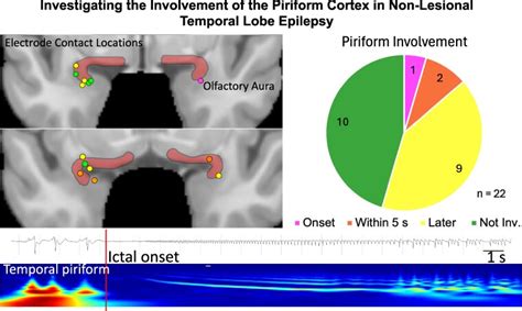 The Involvement Of The Piriform Cortex In Non Lesional Temporal Lobe
