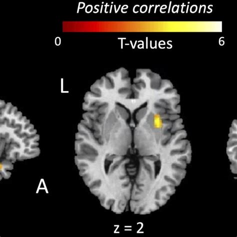 Functional Connectivity Of The Primary Motor Cortex Is Reduced In Download Scientific Diagram