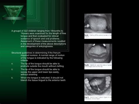 Ankyloglossia Tongue Tie