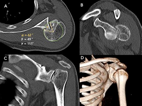 Modified Mclaughlin Procedure Using A Double Row Suture Anchor For Chronic Locked Posterior