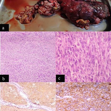 Pathologic Analysis Of The Gastrointestinal Stromal Tumor Gist Download Scientific Diagram