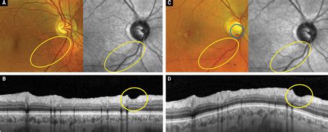 Progression In Glaucoma How To Recognize And React