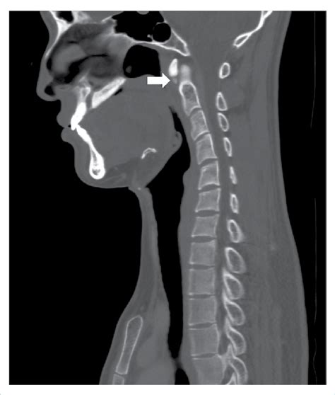 Sagittal View Computed Tomography Image Of The Neck Demonstrating Download Scientific Diagram