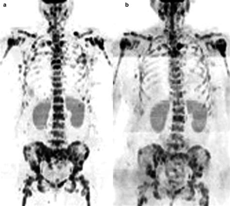 Diffusion Weighted Mr Imaging Radiology Key