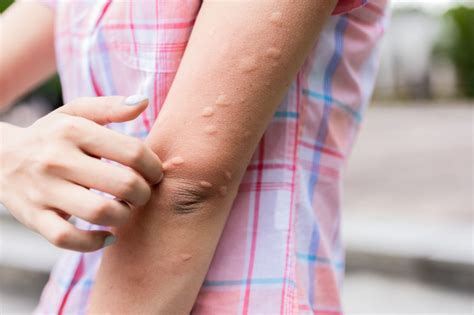 Fungal Infection Of The Skin Healthtips By Teleme