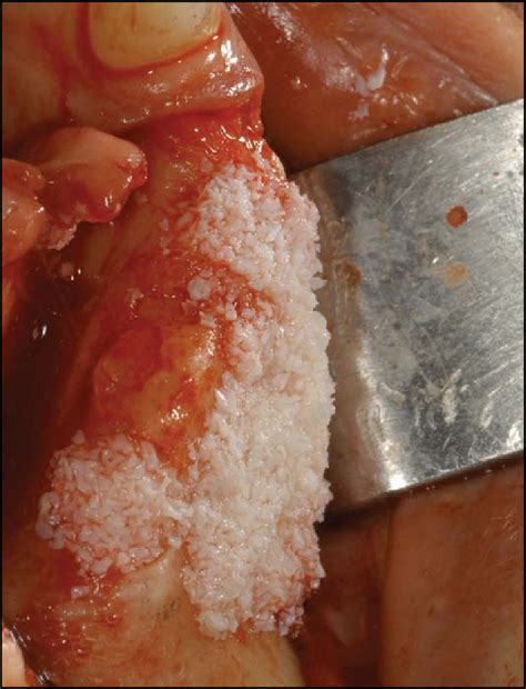 Osseous Defect Grafted With Biooss Occlusal View Download