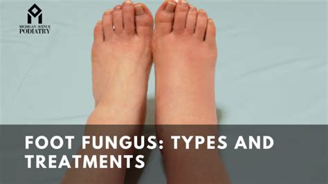 Foot Fungus Types And Treatments