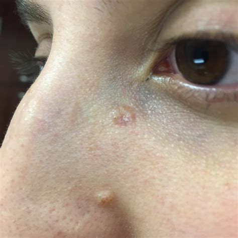 Another Skin Cancer Excision And Reconstruction Story This Young Patient Attended My Clinic