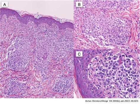Translated Article Granulomatous Secondary Syphilis Suggested By