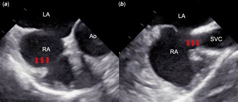 Cyanosis In Atrial Septal Defect With Prominent Crista Terminalis Cardiology In The Young