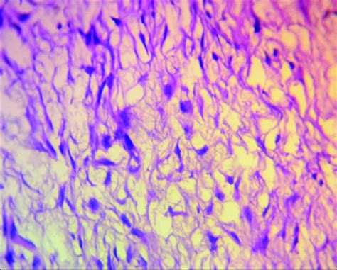 Photomicrograph ×400 Showing Myxoid Stroma With Spindle Download Scientific Diagram