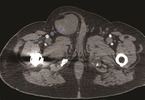 Groin Spindle Cell Sarcoma Applied Radiology
