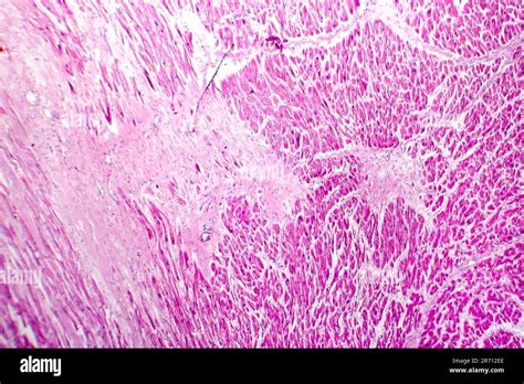Myocardial Infarction Histology