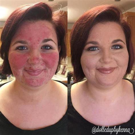 Rhinophyma Rosacea Treatment Rhinoplasty Cost Pics Reviews Qanda