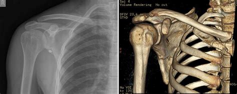 Sports Injury Bulletin Diagnose And Treat Uncommon Injury Scapular