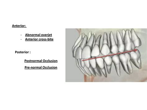 Classification Of Occlusion And Malocclusion Dr Nabil Al Zubair Pdf