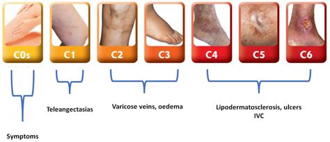Ceap C Classes Cvi Chronic Venous Insufficiency Download Scientific Diagram