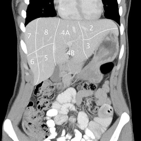 Hepatic Segmental Anatomy By Alexander Baxter Radnotes